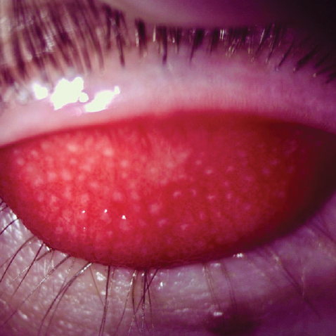 Giant Papillary Conjunctivitis: Diagnostic Pearls
