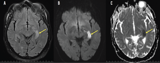A Case of Multiple Visual Field Defects Secondary to G...
