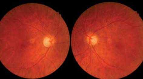 First-Line Treatment Options for Glaucoma
