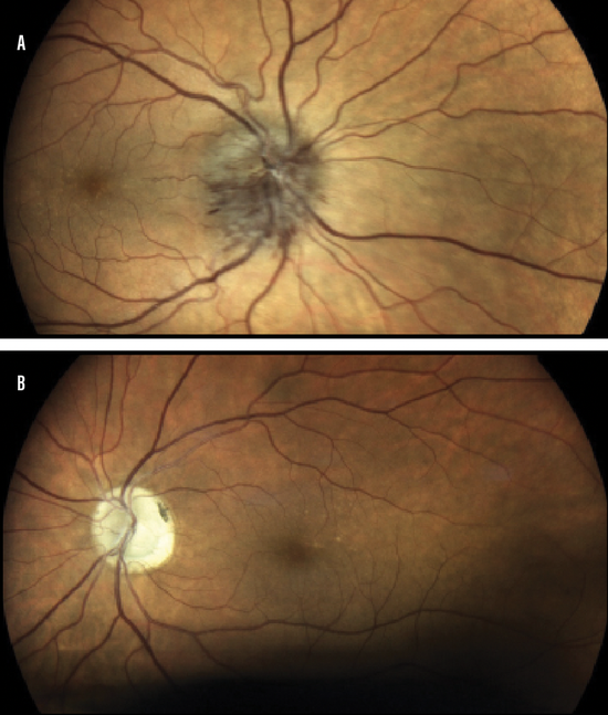 NAION: Don’t Forget the Other Eye