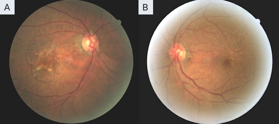 GA Case Compendium: Multimodal Imaging for Following Geo