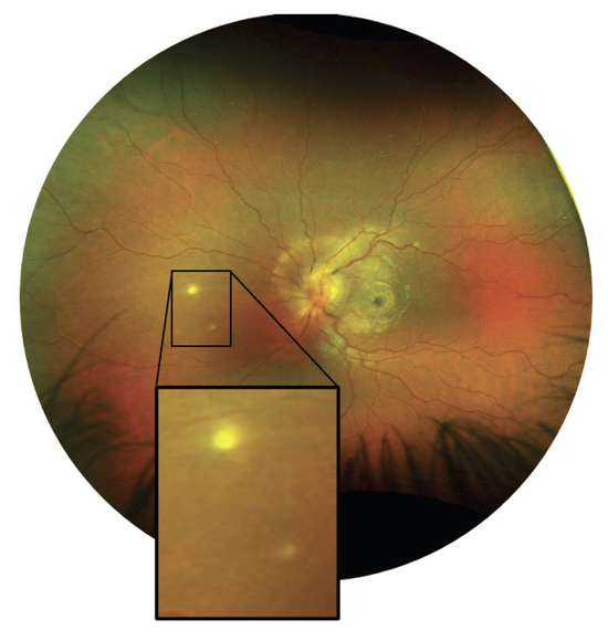 Neuroretinitis From Cat Scratch Disease