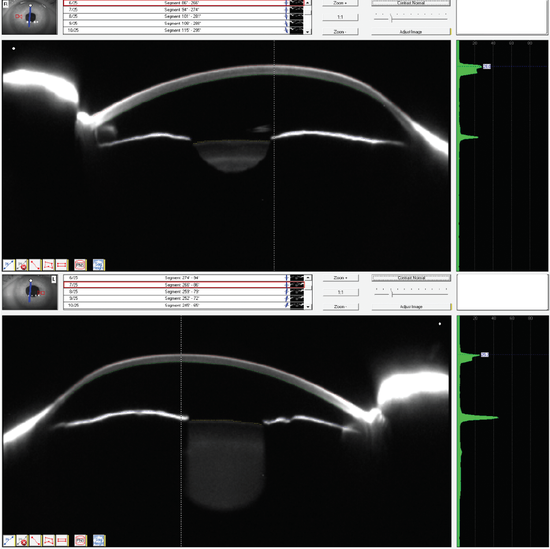 Pentacam CSP Software to Improve Efficiency and Effica...