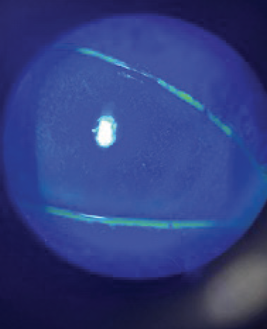 Neurotrophic Keratitis Secondary to Long-Duration Cont...