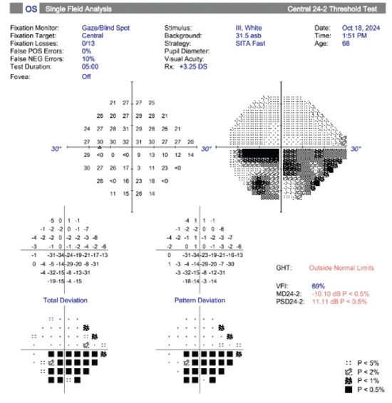 Rationalizing the Red: When RNFL Atrophy Is Not Glaucoma