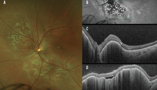 Understanding Ocular Metastatic Tumors and Simulating ... -