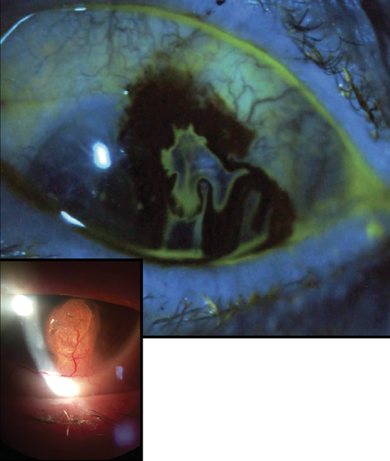 Managing Ocular Perforations