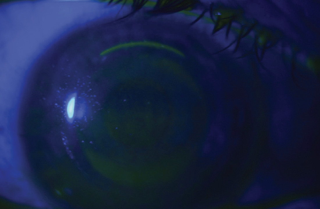 The Pros and Cons of LASIK vs SMILE