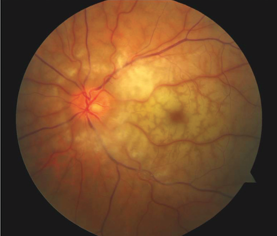 Retinal Artery Occlusion: A Sign of Stroke