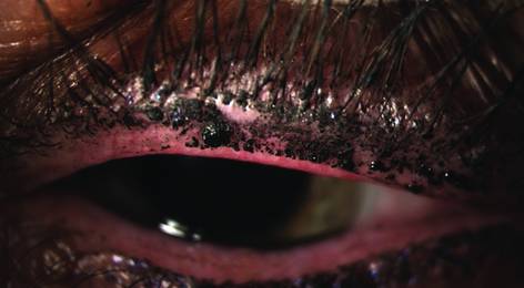 Surveying the Options for Treating Demodex