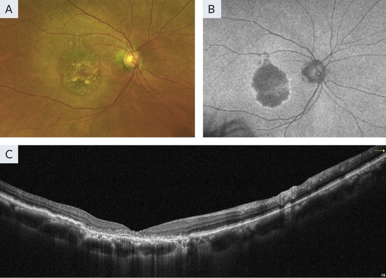 GA Case Compendium: Multimodal Imaging for Following Geo