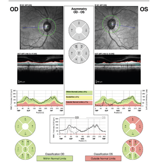 Rationalizing the Red: When RNFL Atrophy Is Not Glaucoma
