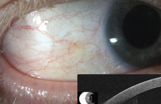 Ocular Surface Squamous Neoplasia in an Avid Sailor Wi...