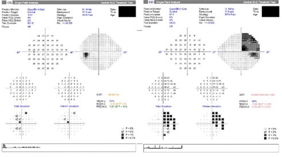Ocular Effects of Pituitary Tumor