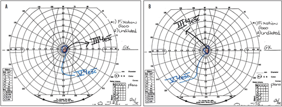 Managing a Case of Retinitis Pigmentosa