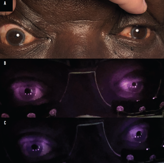 Horner Syndrome Secondary to Bullet Fragments