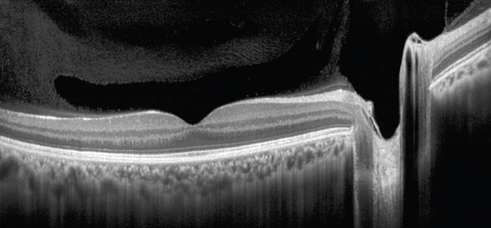 Know Your Vitreomacular Interface Disorders