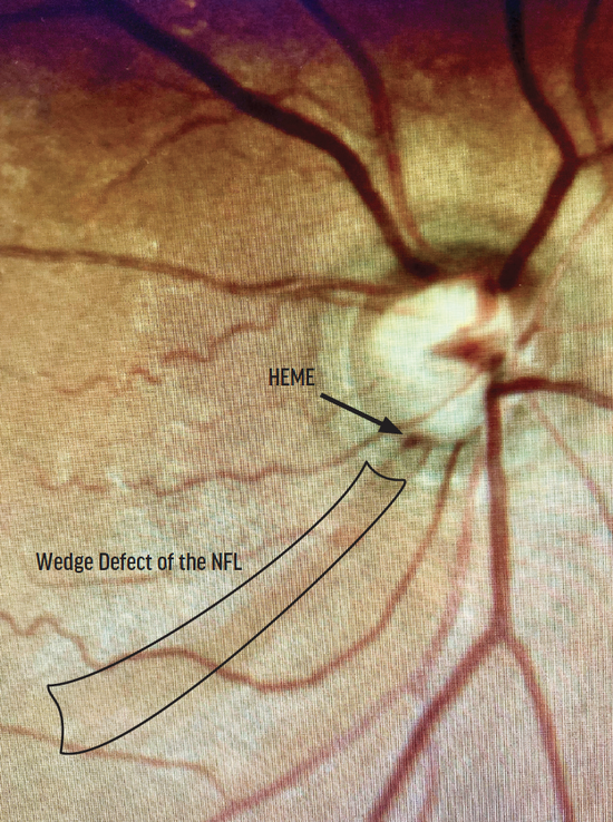 Optic Nerve Hemorrhages and Glaucoma