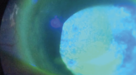 Bitot Spots