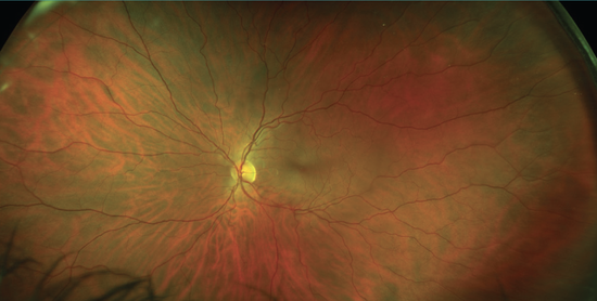 Beware the Floaters - Modern Optometry