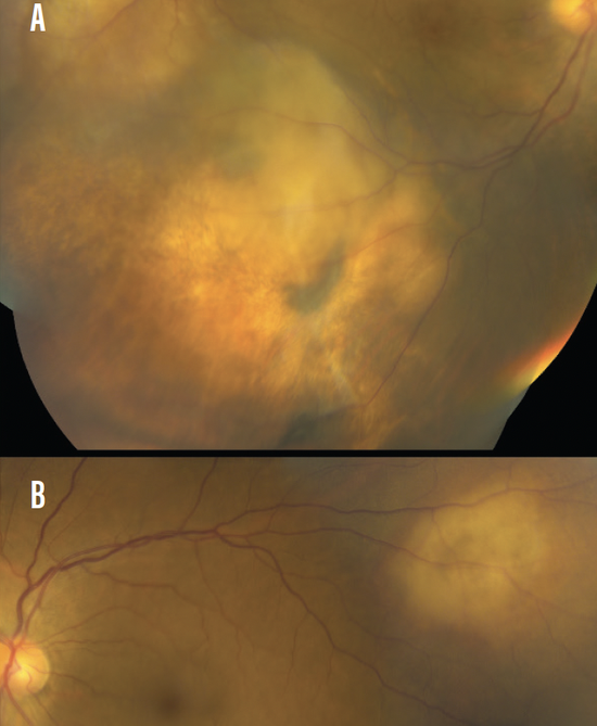 Understanding Ocular Metastatic Tumors and Simulating ... -
