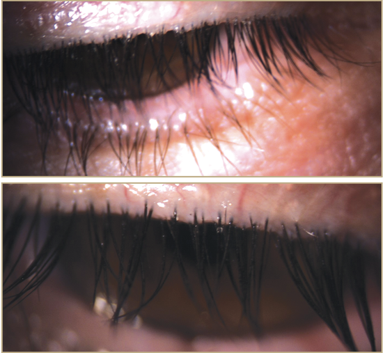 The Demodex Blepharitis PatientJourney With XDEMVY®