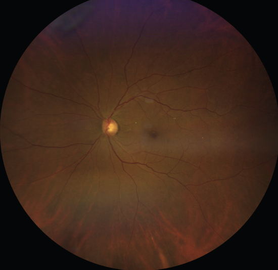 An Ocular Sign of Cardiovascular Disease