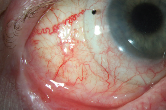 Managing Ocular Cicatricial Pemphigoid-Related OSD