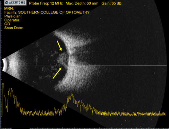 Persistent Fetal Vasculature