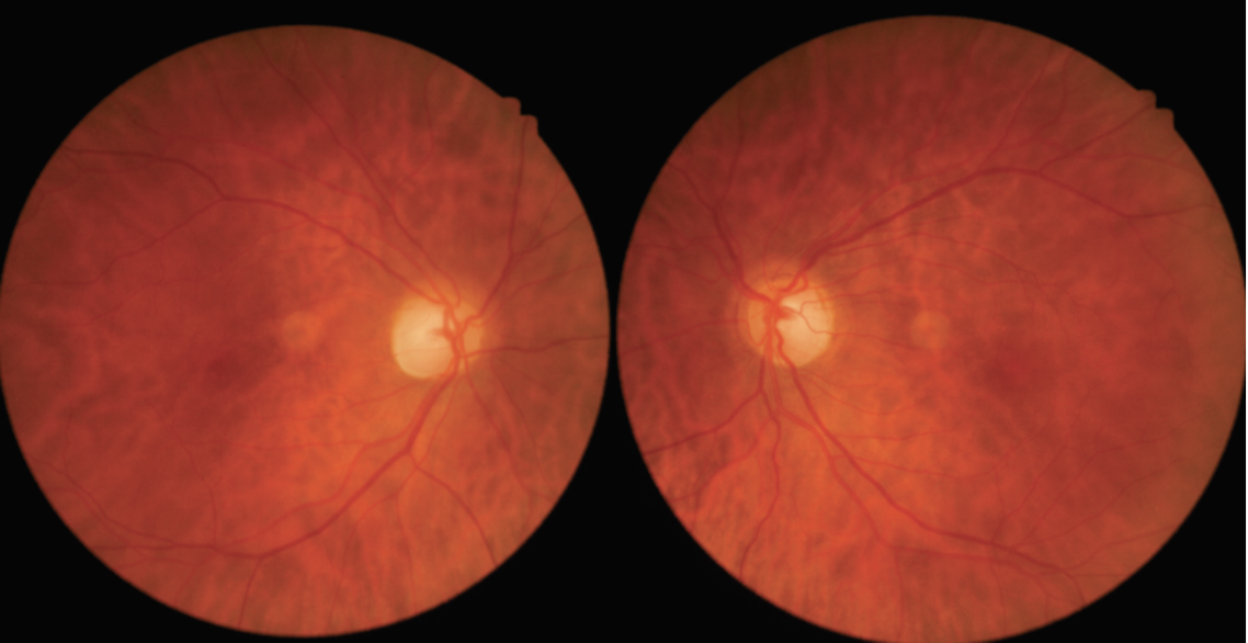 Meningioma Masquerader - Modern Optometry