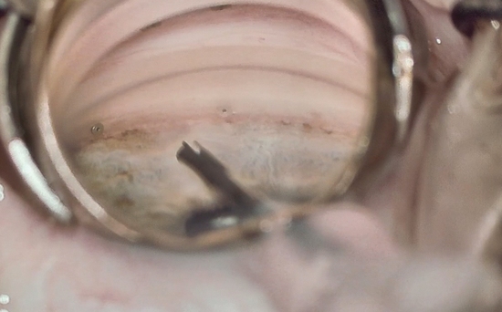 Interventional Glaucoma and the OD’s Role - Modern Optometry