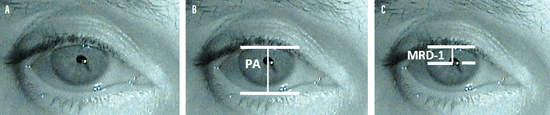 Ocular Ptosis and Its Differential Diagnosis