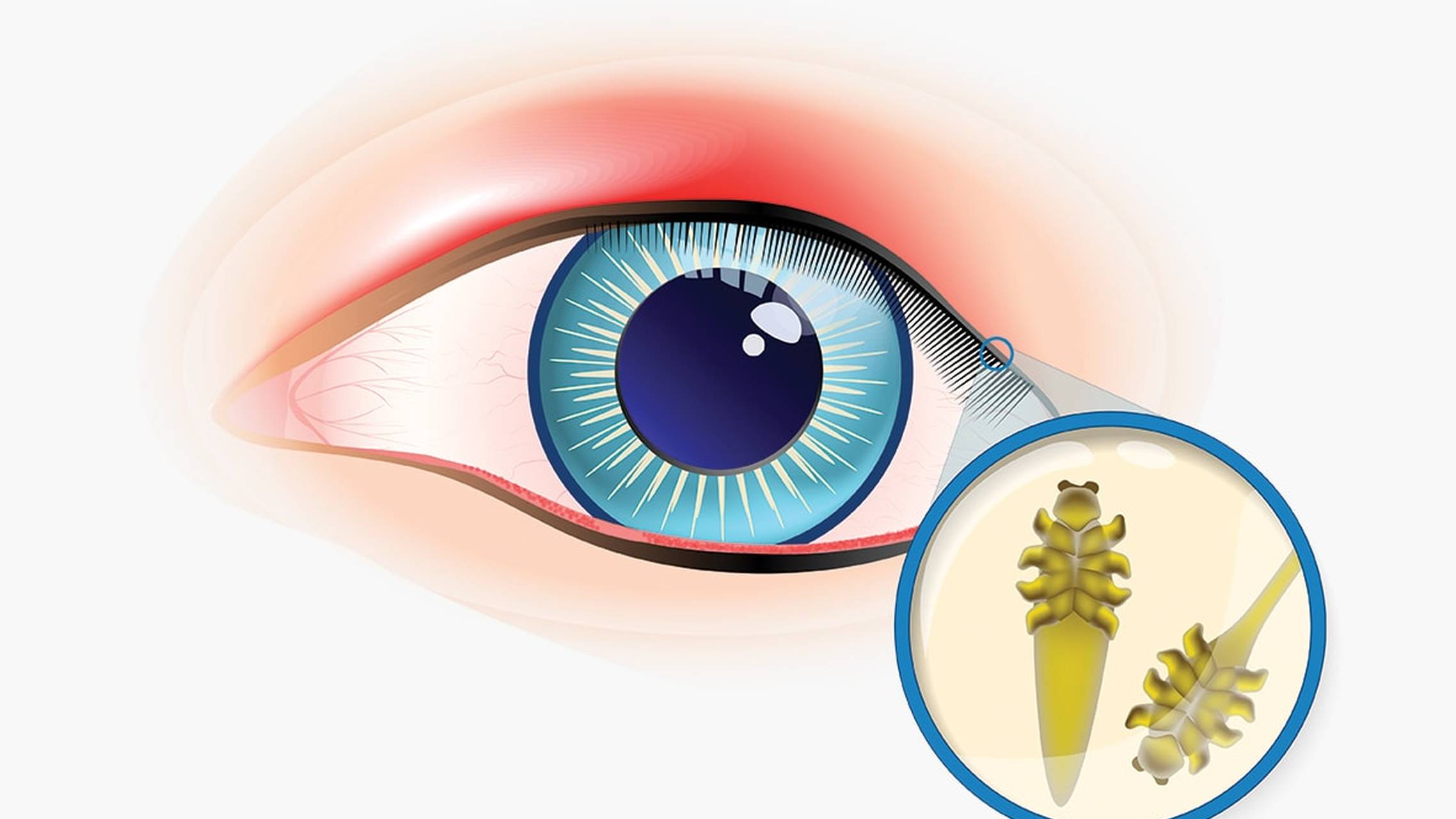 A Primer on Demodex Blepharitis
