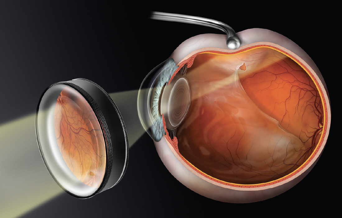 Clinical Tips to Perform Effective Scleral Indentation