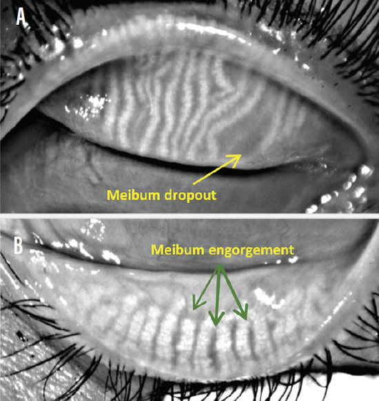 Essentials for Diagnosing OSD