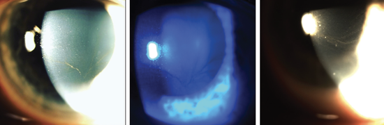 A Review of Medications That Can Affect the Cornea