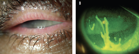 The Ocular Manifestations of GVHD
