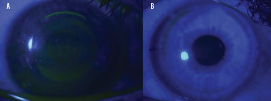 The Pros and Cons of LASIK vs SMILE