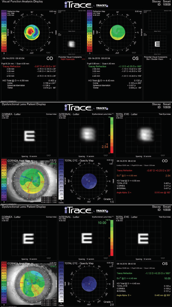 Assessing PRK and LASIK Patients