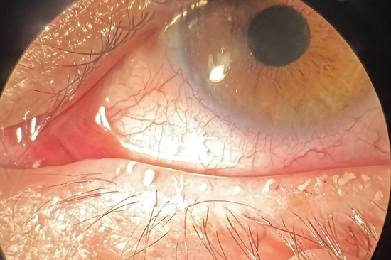 Breaking Down MGD Treatments Through the Lens of Sebac...