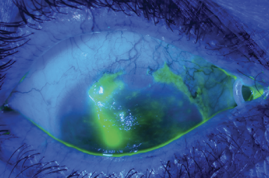 Managing Ocular Cicatricial Pemphigoid-Related OSD