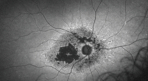 Neuroretinitis From Cat Scratch Disease