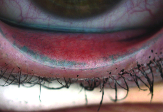 Turning Dry Eye Evidence Into Action