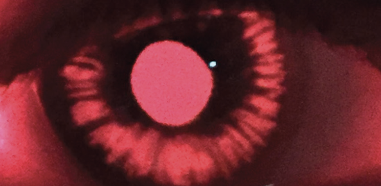 Pigmentary Dispersion Syndrome and Pigmentary Glaucoma