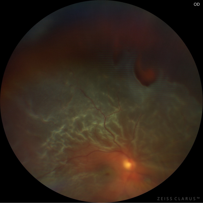 Keep Cataracts at Bay With Physical Activity