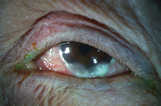 Managing Ocular Cicatricial Pemphigoid-Related OSD