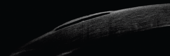 The Optometrist’s Guide to Fuchs Endothelial Corneal D...