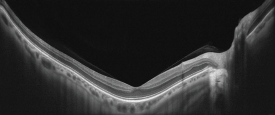 Know Your Vitreomacular Interface Disorders