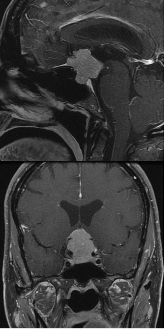 Meningioma Masquerader - Modern Optometry