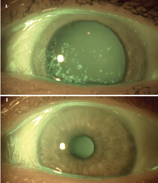 Platelet-Rich Plasma Eye Drops for Dry Eye Disease